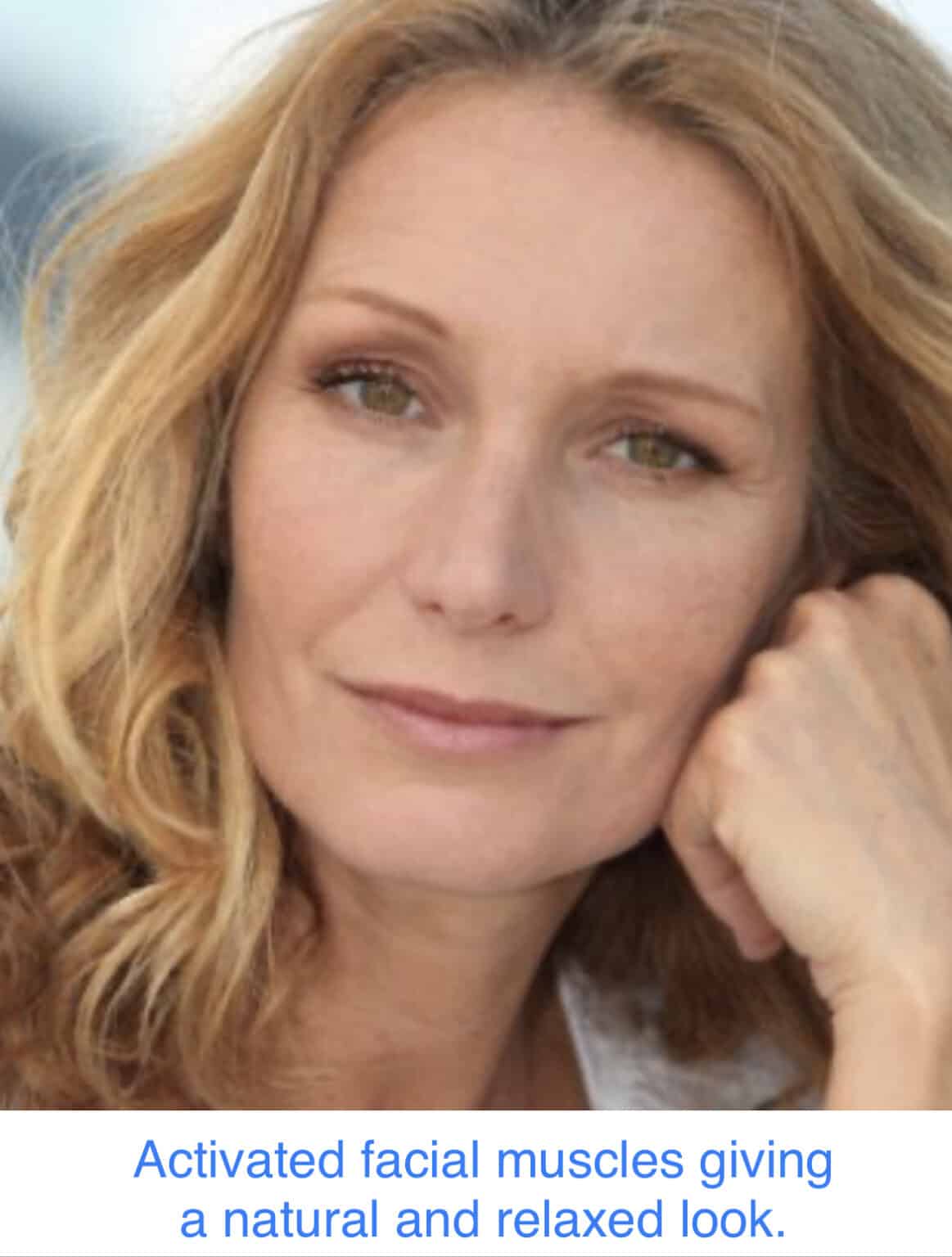 Facial Muscles and Facial tone: Improvement of a SAD Facial Appearance ...